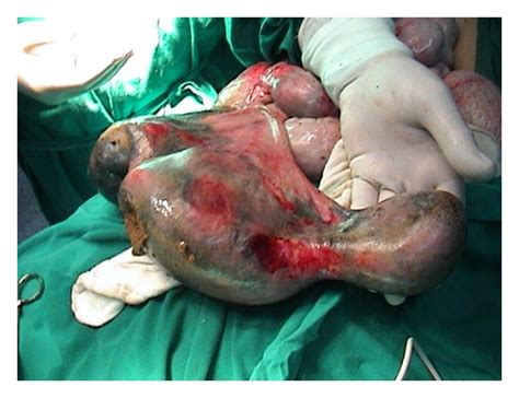 Intraoperative View Showing The Appendix That Measured About Cm And Download Scientific