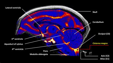 Figure 1 From Xperct Guided Intra Cisterna Magna Injection Of