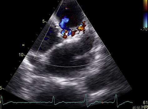Transthoracic Echocardiogram Parasternal Shortaxis View With Color