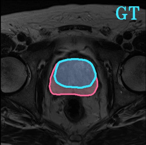 210208005 Transfuse Fusing Transformers And Cnns For Medical Image Segmentation