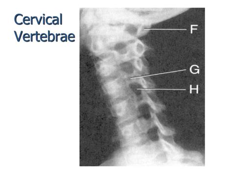 Oblique View Of Cspine Diagram Quizlet