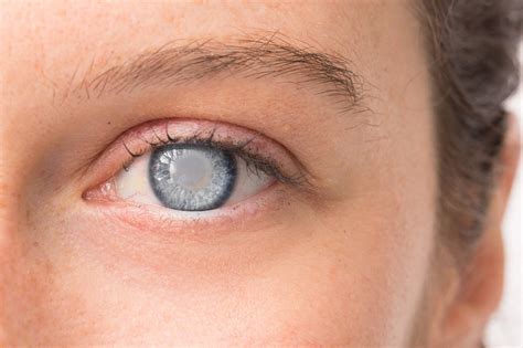 常见致盲性眼病白内障你真的了解吗 健康界