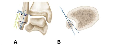 Fibular Length And Rotation Measurements A Line D Is Drawn Following