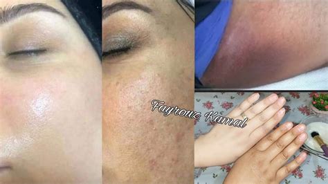 تخجلين من سواد العنق والعانه والمناطق الحساسة الإبطينالمهبلالرقبه