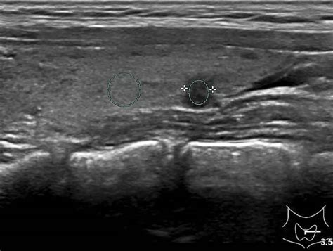 The Value Of Ultrasound Grayscale Ratio In The Diagnosis Of Papillary