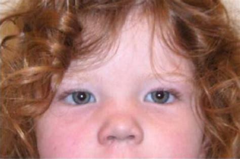 Triple X Syndrome Causes Symptoms Diagnosis Treatment