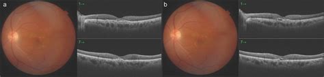 Visual And Anatomical Outcomes After Initial Intravitreal Faricimab Injection For Neovascular