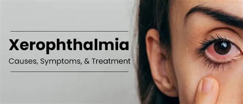 What Is Xeropthalmia Causes Symptoms And Treatment Options