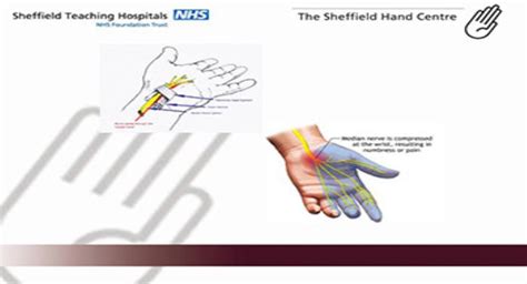 Download Free Medical Carpal Tunnel Syndrome Powerpoint Presentation