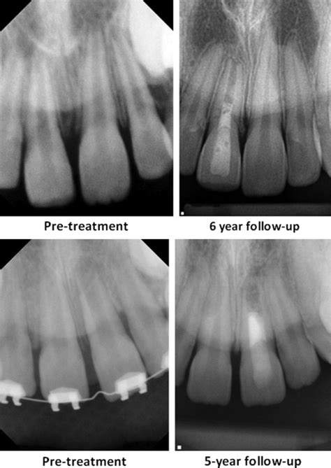 Outcomes Of Regenerative Endodontic Procedures Pocket Dentistry