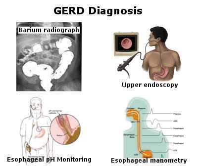 GERD Diagnosis Gerd Diagnosis Acid Reflux