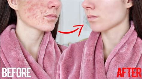 How To Get Clear Skin Fast The Real Way Youtube