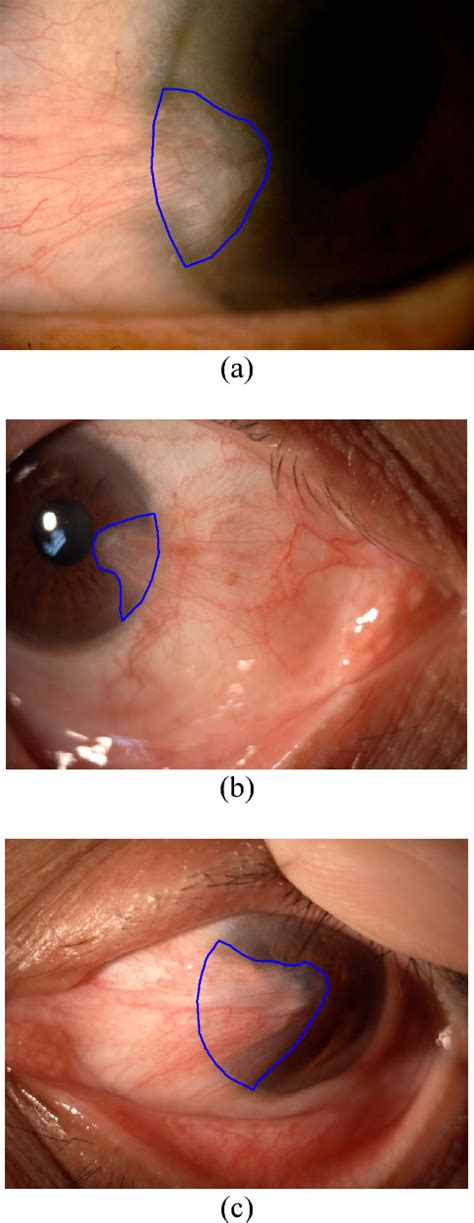figure 2 from fibrovascular redness grading using gaussian process