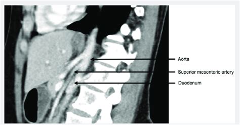 Computed Tomography Of The Abdomen With Contrast Sagittal View Showed