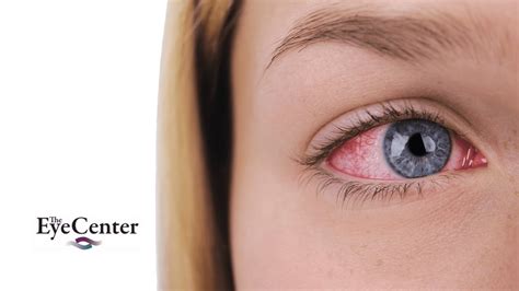 How Smoking Harms Your Eyes The Eye Center