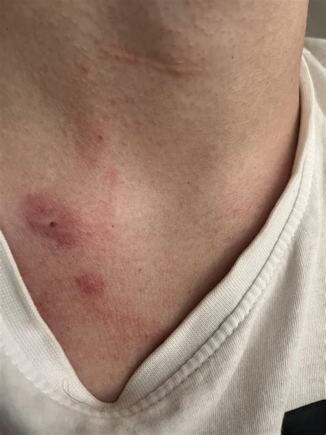 Bee Sting Reaction Rbees
