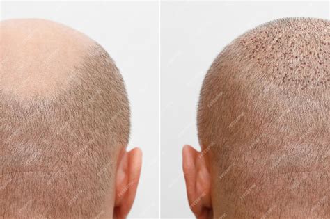 Premium Photo The Head Of A Balding Man Before And After Hair