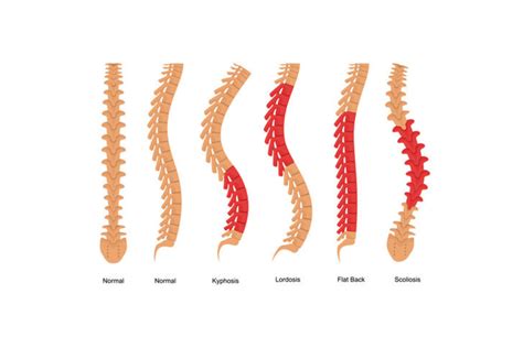 How To Fix Lordosis Doctor Recommended Lordosis Treatment Backembrace