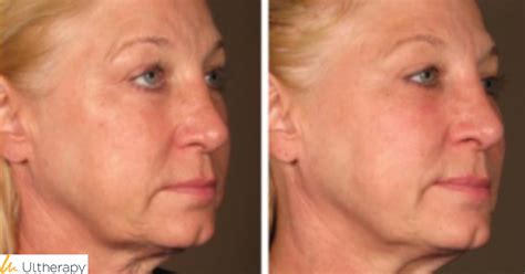 Non Surgical Facelifts Using Ultherapy The Body Work Clinic