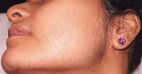 Unwanted Facial Hair মুখের অবাঞ্ছিত লোম নিয়ে অস্বস্তিতে ভোগেন