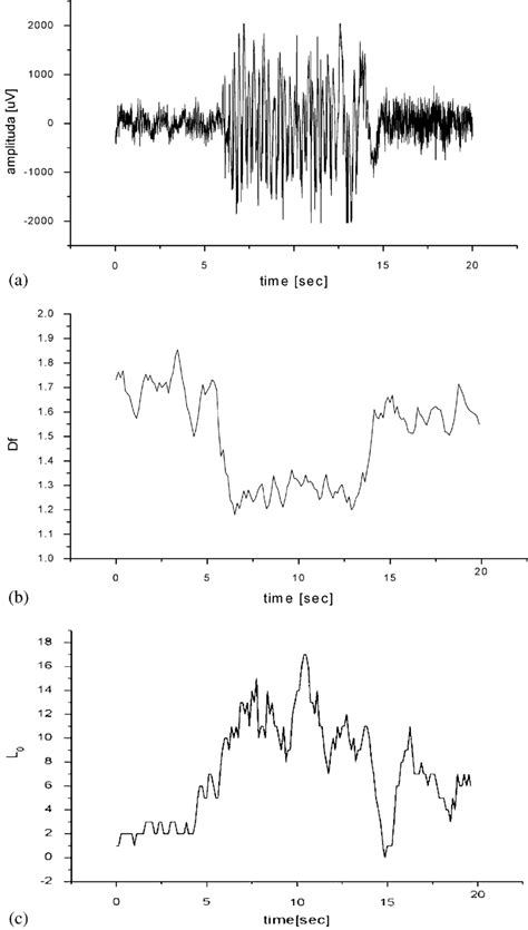 A Spike Wave Epileptic Discharge Recorded In A Eeg Signal Sampled Download Scientific