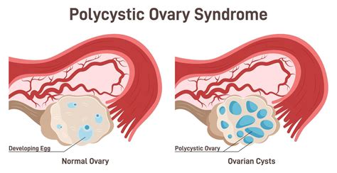 Polycystic Ovary Syndrome Pcos Hormonal Disease Female Reproductive