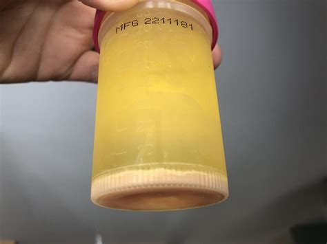 Urine Sediment Mystery R Pathology