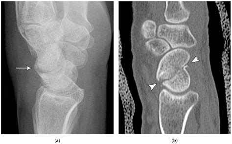 Imaging Diagnosis And Management Of Carpal Trauma And Instability—an