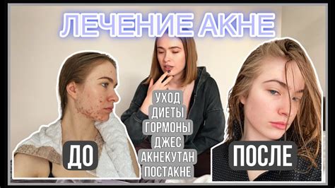 ЛЕЧЕНИЕ АКНЕ: 11 лет экспериментов. АКНЕКУТАН, ДЖЕС, ДИЕТЫ. - YouTube