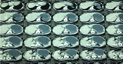Ct Scan Of Abdomen With Iv Contrast Show Two Huge Cysts Between Spleen