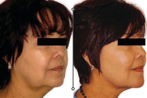 How Can Venus Freeze Help Smoothen Skin B At The Top Medical Aesthetics