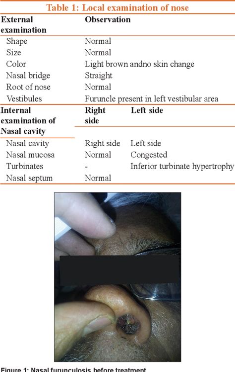 Nasal Furunculosis Diagnosis In Otorhinolaryngology Onerci 2009