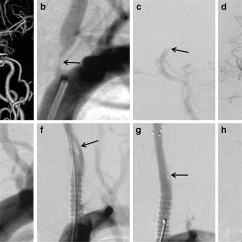 Path 1 Case No 13 The Initial Angiogram Revealed The V4 Segment Of