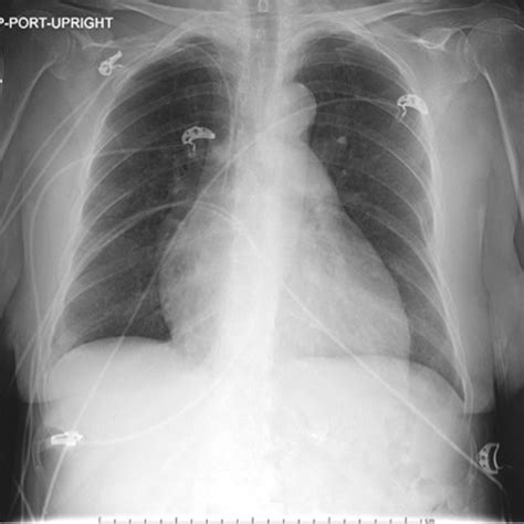 Portable Chest Radiograph Demonstrating Diffuse Faint Reticular Nodular Download Scientific