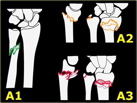 Colles Fracture Classification