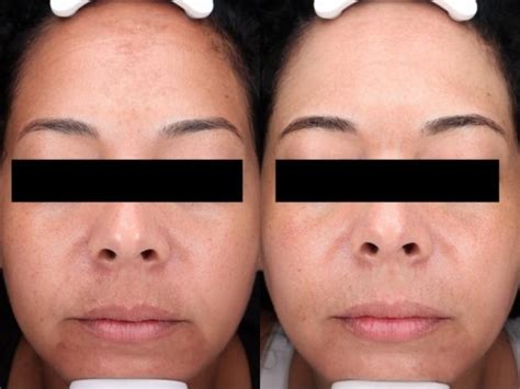 Moxi Before And After Photo Gallery Rochester Ny Q The Medical Spa