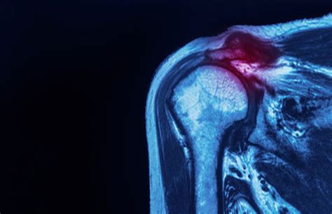 Rotator Cuff Tendinopathy Causes And Best Treatment Options In 2025
