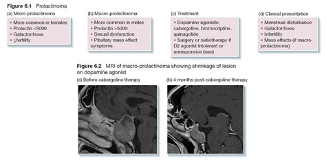 Prolactinoma And Hyperprolactinaemia Pediagenosis
