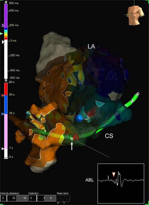 Usefulness Of Omnipolar Technology Near Field For Accessory Pathway