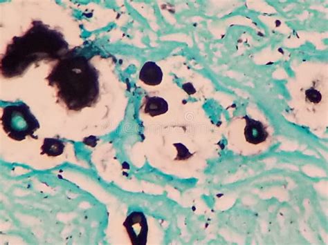 Cryptococcus Neoformans In Lung Tissue Warthin Starry Silver Stain Stock Photo Image Of