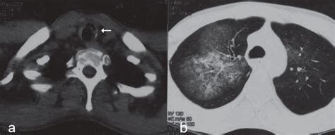 A The Neck Ct Scan Shows A Thickened Anterior Wall Of The Trachea