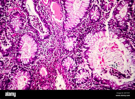 Adénocarcinome du côlon villeux micrographe léger photo sous