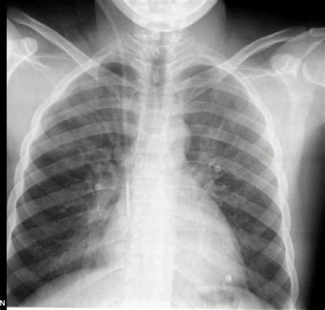 Percutaneous Central Catheter