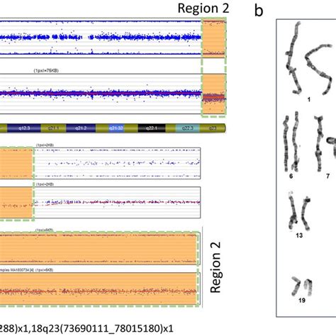 Snp Microarray And Karyotype Analyses Identified A Ring Chromosome 18
