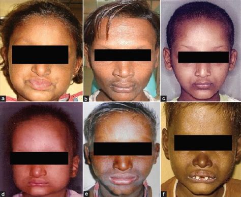 Extra Oral Photographs Of Patients With Ectodermal Dysplasia Download Scientific Diagram