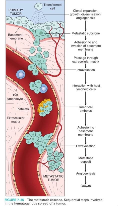 Metastasis By Hematogenous Route Pathology Map Route