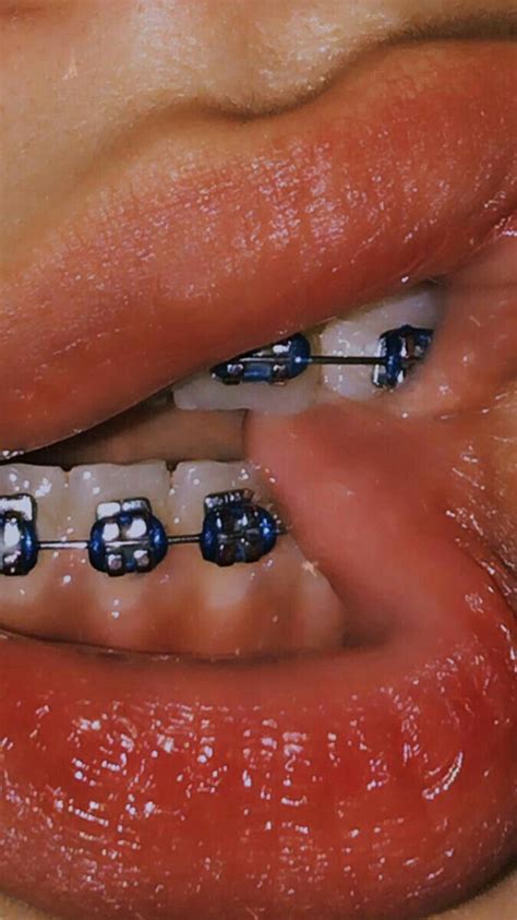 Pinterest Braces Colors Teeth Braces Braces Tips