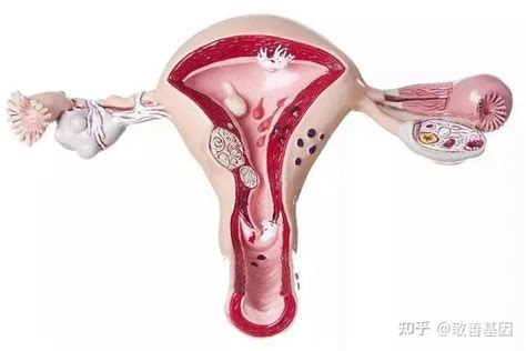 宫颈锥切该怎么选 知乎