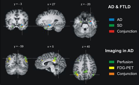 And Frontotemporal Lobar