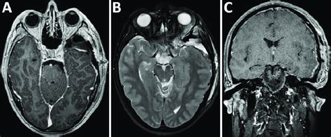 Postoperative Contrasted T1 Axial Mri A T2 Axial Mri B And